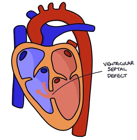 Ventricular Septal Defect Types