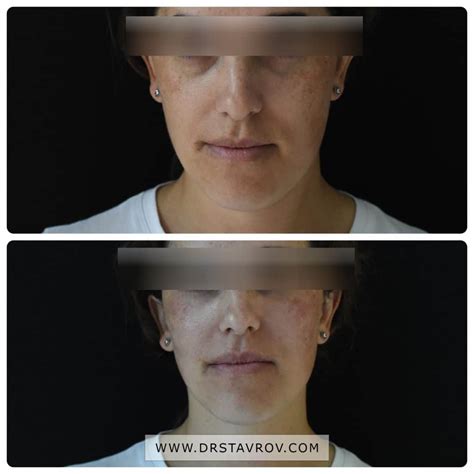 Филър под очите Мнения Цена Dr Stavrov Aesthetics в София