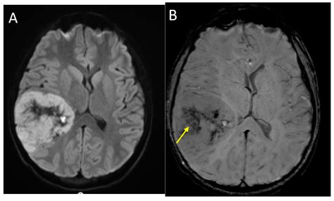 3d Brain Mri Classification