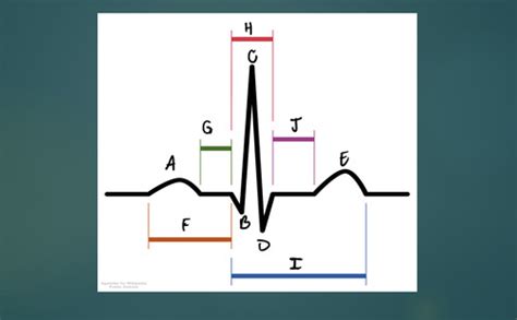 EKG Intro Part II Flashcards Quizlet