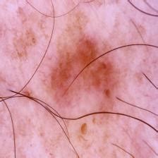 Skin Cancer Detection Classification Dataset And Pre Trained Model By North South University