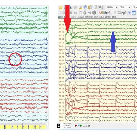 A EEG In Wakefulness With Left Temporal Sharp And Spike Wave SW Download Scientific