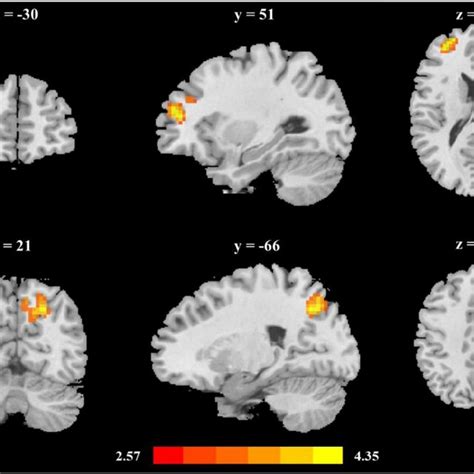 The Two Cortico Subcortical Reading Pathways A Reading Ability Was Download Scientific