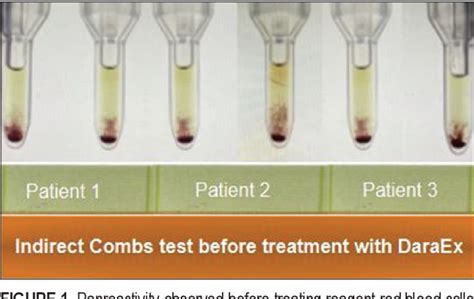 Figure 1 From The Importance Of Removing Interference Caused By Darzalex® Daratumumab In Pre