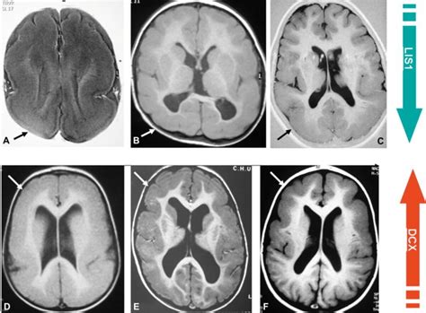 50 Facts About Lissencephaly