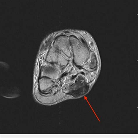Case 3 Mri Showing The T1 Weighted Sagittal Image Of The Right Foot