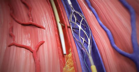 Fda Approves New Minimally Invasive Clti Treatment For ‘no Option
