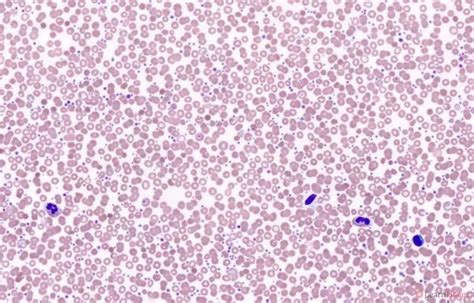 Polycythaemia Vera LearnHaem Haematology Made Simple