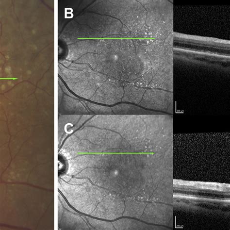 Clinicopathologic Correlation Of Nonexudative Type 1 Macular Download Scientific Diagram