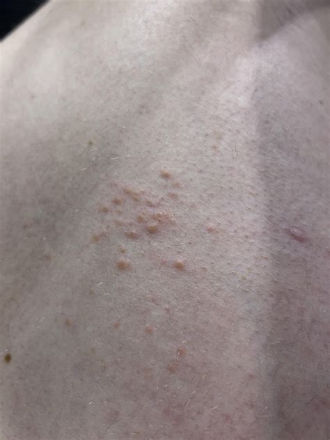 Can This Be Fungal Itchiness Is Gone After A Showercleanse But Comes