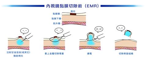 內視鏡膜切除術endoscopic Mucosal Resection Emr、內視鏡黏膜下剝離術endoscopic