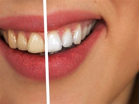 Voici Les Meilleures Astuces Pour Blanchir Ses Dents Sans Produit