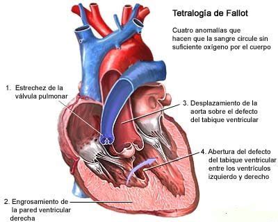 Tetralogía de Fallot
