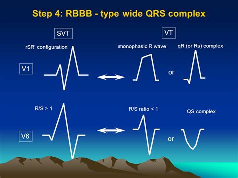 Approach To Wide Qrs Complex Tachycardia Ppt Video Online Download