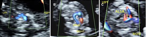 Abnormal Ultrasound Image Pattern Of The Bilateral Subclavian Artery