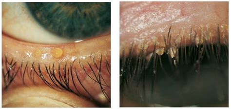 Blepharitis Melina Joy Opticians