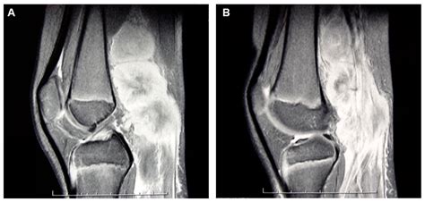 Popliteal Lymph Nodes Mri