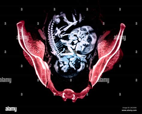 Coloured Computed Tomography Ct Scan Of Twin Foetuses In A Womans