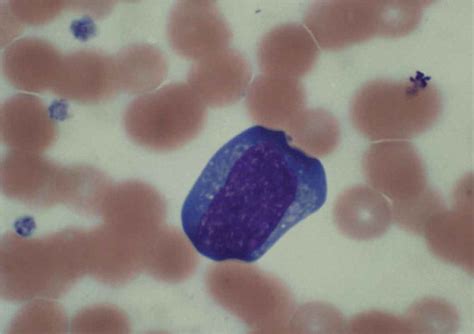 Atypical Lymphocytes Infectious Mononucleosis