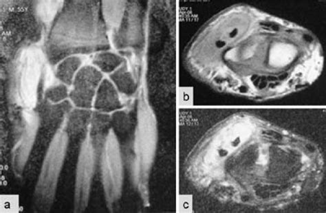 Magnetic Resonance Imaging Of The Wrist Download Scientific Diagram