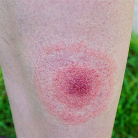 Wheel Bug Bite Symptoms