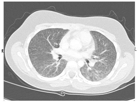 Bird Lung Disease