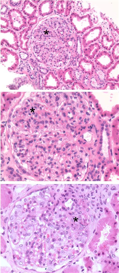 Class Ii Lupus Nephritis Showing Mesangial Hypercellularity