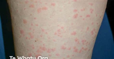 Pemphigoid Gestationis 00016 Image