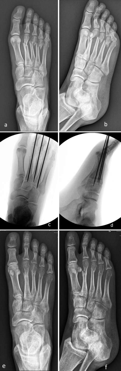 Metatarsal Head Fracture