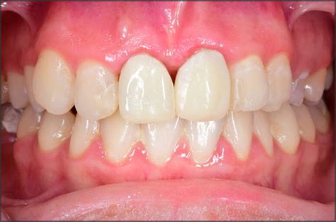 Receding Gums Causes Prevention And Treatment Options