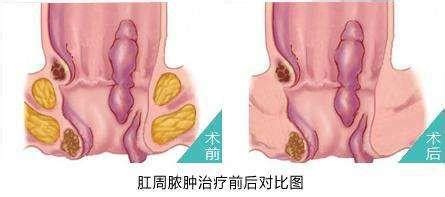 肛管直肠周围脓肿多图 39医疗图集 39健康网