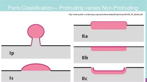 Kudos To You Learning Your Kudo Pit Patterns And Paris Polyp Classif