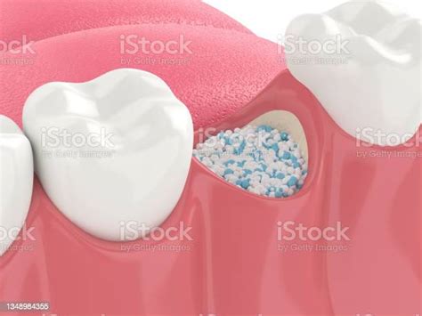 폐포에 치과 뼈 생체 재료와 치과 뼈 이식의 3d 렌더링 건강관리와 의술에 대한 스톡 사진 및 기타 이미지 건강관리와 의술