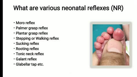 Neonatal Reflex Plantar Grasp Reflex Pediatrics YouTube