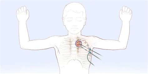 Sympathectomy For Hyperhidrosis Dubai Thoracic Surgery Clinic