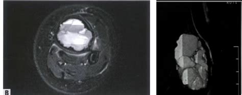 Aneurysmal Bone Cyst Medsci Cn
