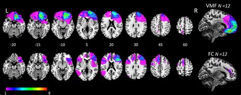 Lesion Overlap In The Vmf Top Row And Fc Bottom Row Groups Colors