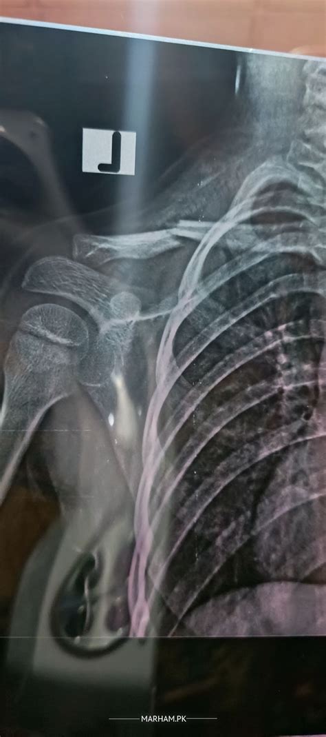 Ask A Orthopedic Surgeon Online For Shoulder Bone Fracture