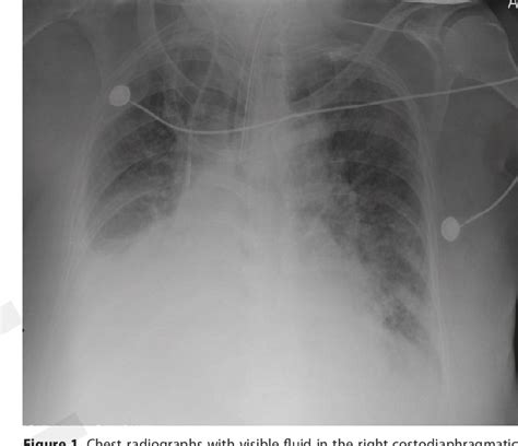 Figure 1 From A Case Of Exudative Pleuritis Caused By Staphylococcus