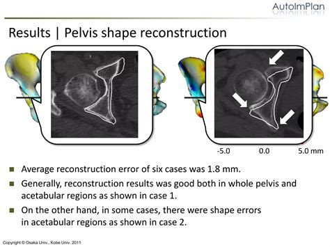 An Automated 3d Cup Planning In Total Hip Arthroplasty From A Standard X‑ray Radiograph Using
