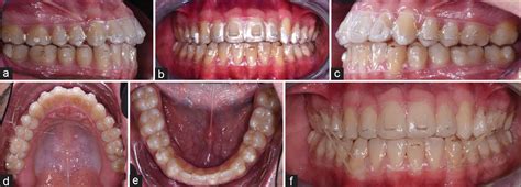 Clear Aligners For Class Iii Malocclusion And Severe Open Bite