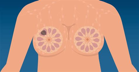 What Is A Lumpectomy For Breast Cancer