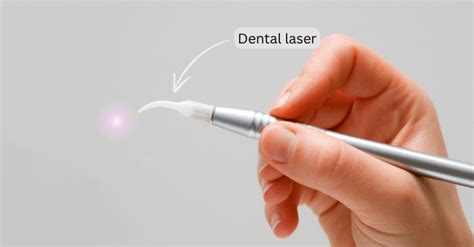 Gingivoplasty Explained Benefits Procedure And Aftercare Tips Share