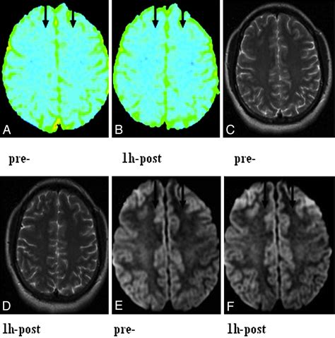 Alcohol And Depression Brain Scan