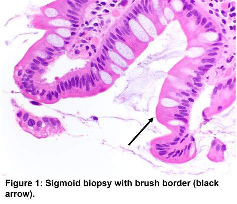 European Crohn´s And Colitis Organisation Ecco P754 Beyond Paneth