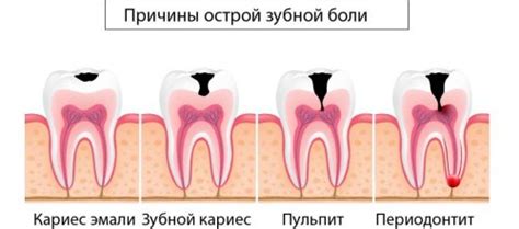 Топ-11 лучших таблеток от зубной боли - Стоматология - Статьи - Поиск ...