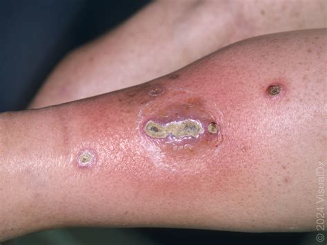 Pyoderma Dermalive