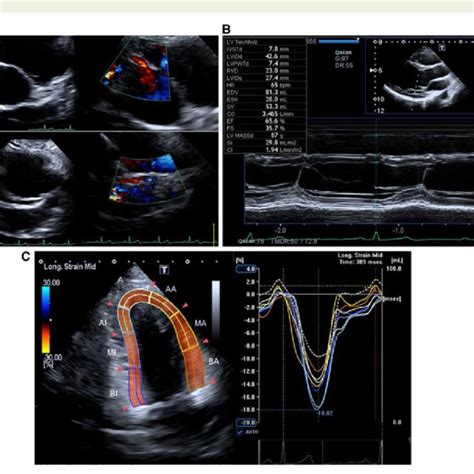 Transthoracic Echocardiogram Normal Origins Of Coronary Arteries A
