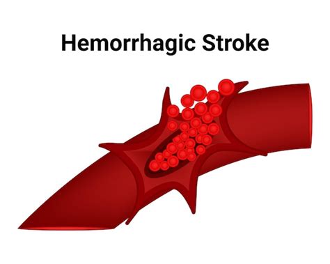 Premium Vector Hemorrhagic Stroke Vector Illustration