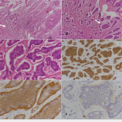 Well Differentiated Neuroendocrine Tumor Wdnet Grade 2 Of The